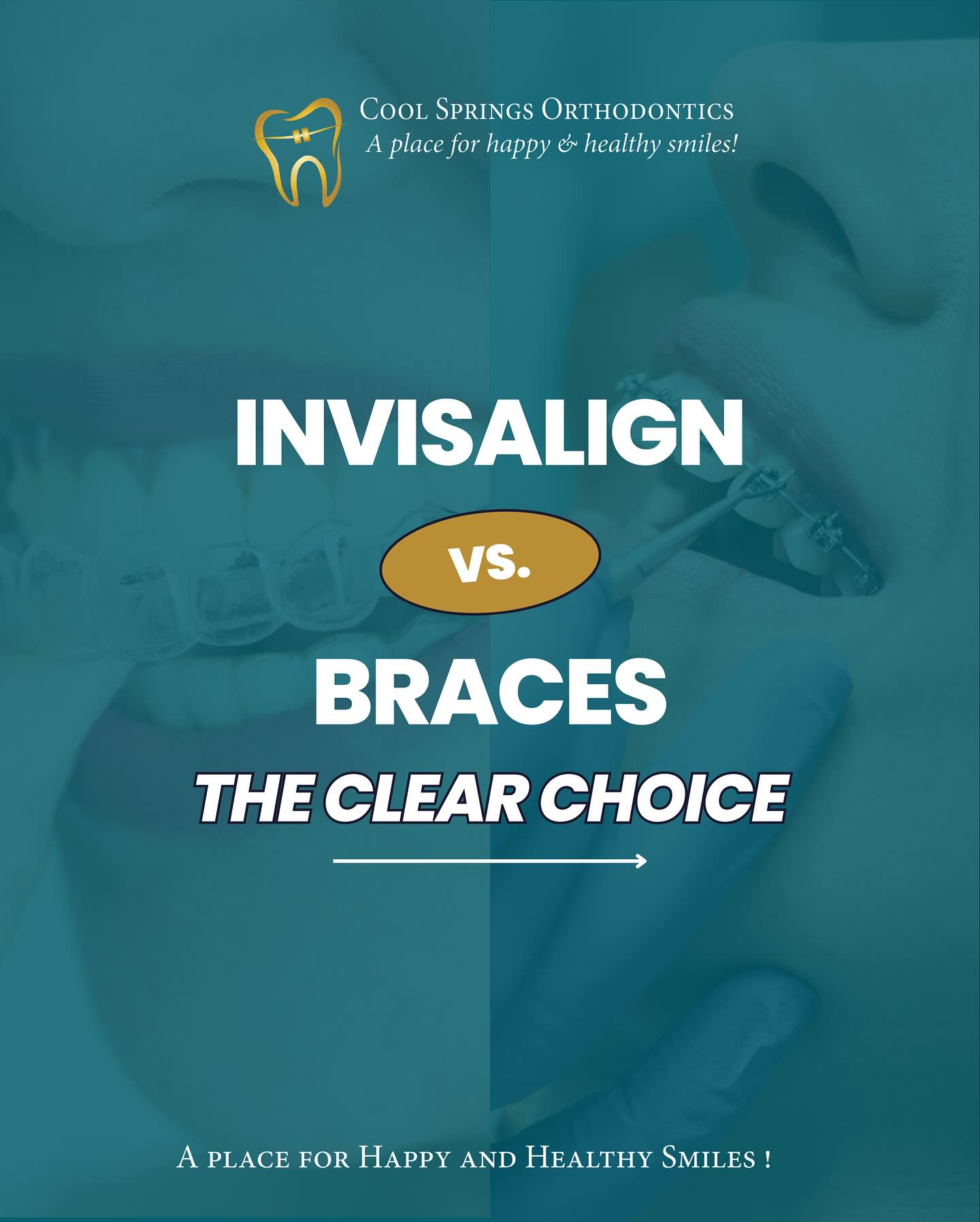 Invisalign Aligners vs. Braces: Which Option is Right for You?